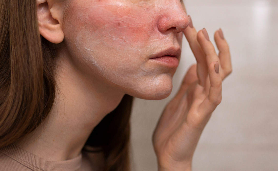 Dermatitis Rash: What It Is and How to Support Your Skin - Eckco